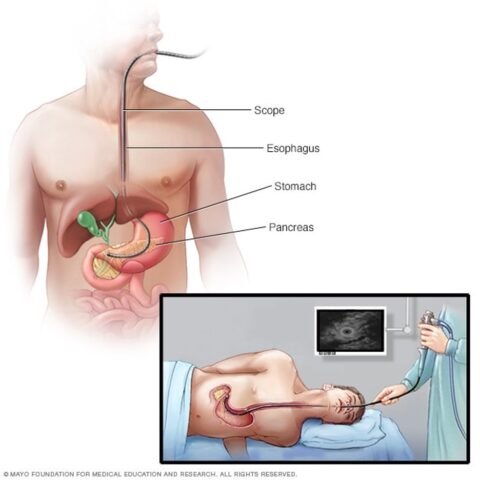 Endoscopic Ultrasound (EUS) Midwest Endoscopy Center